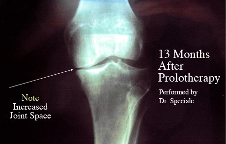 Prolotherapy | Dr. Tim SpecialeDr. Tim Speciale